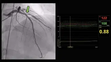 Assessing coronary artery disease using FFR - PressReader