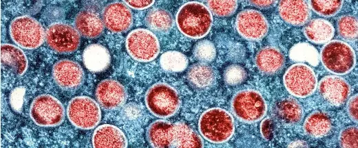 The mpox virus uses a ‘genomic accordion’ to evolve and infect humans ...