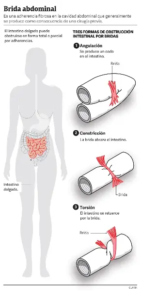 Brida abdominal - PressReader