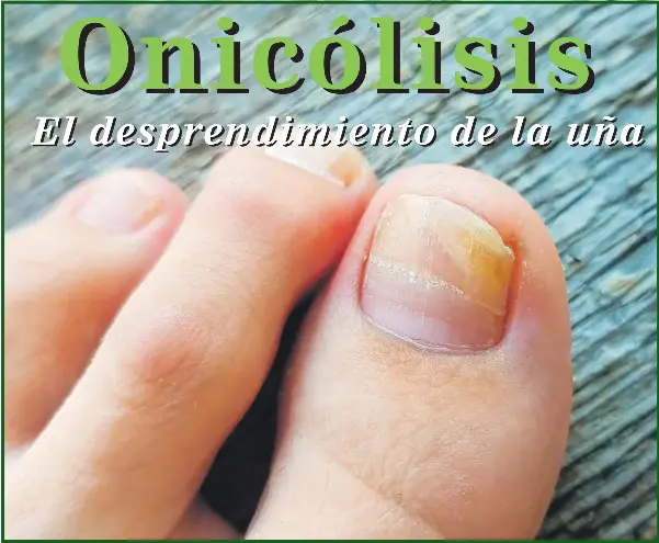Onicólisis - PressReader