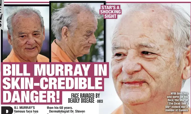 Bill Murray Acne Scars