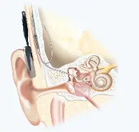 The Truth About Hearing Loss - PressReader