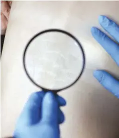 Are stretch marks common during teen years? - PressReader