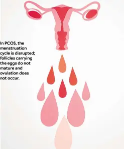 UNDERSTAND­ING PCOS AND WHAT IT DOES TO THE BODY - PressReader