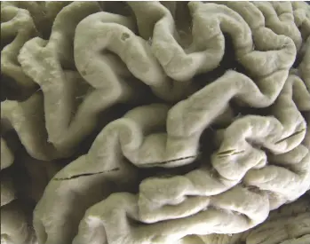 Silent brain changes precede Alzheimer’s. Researcher­s have new clues ...
