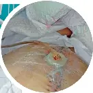 Cirugía fallida: La trágica historia de Yaribeth Murillo - PressReader