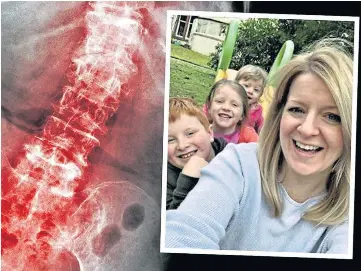 Perthshire mum explains excruciati­ng condition - PressReader