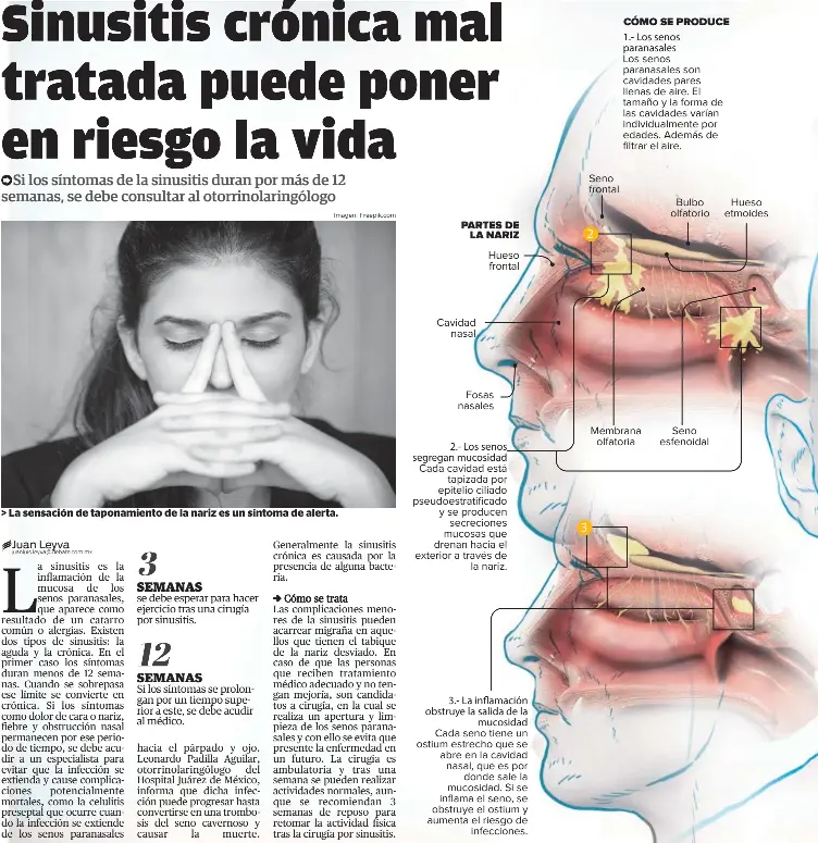 Sinusitis crónica mal tratada puede poner en riesgo la vida - PressReader