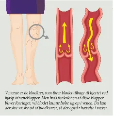 Problemer med vener og trætte ben? - PressReader