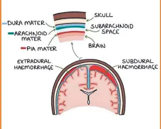 Extradural haematoma: a neurosurgi­cal emergency - PressReader