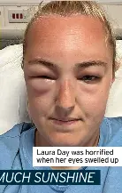 Allergic reaction to sun made my face swell up - PressReader