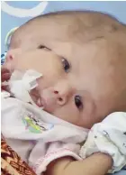 Indonesian baby born with 2 faces needs high-risk surgery - PressReader