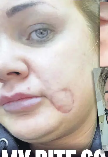 MY BITE SCAR HELL - PressReader