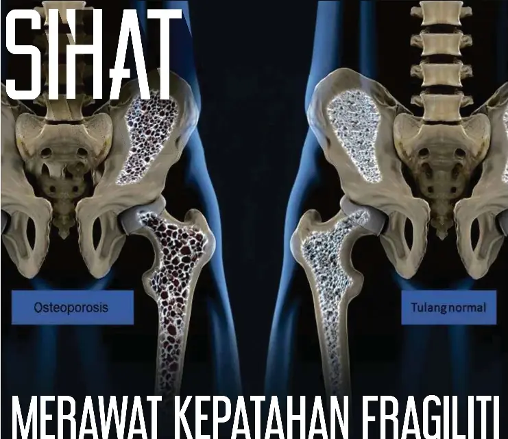 MERAWAT KEPATAHAN FRAGILITI - PressReader