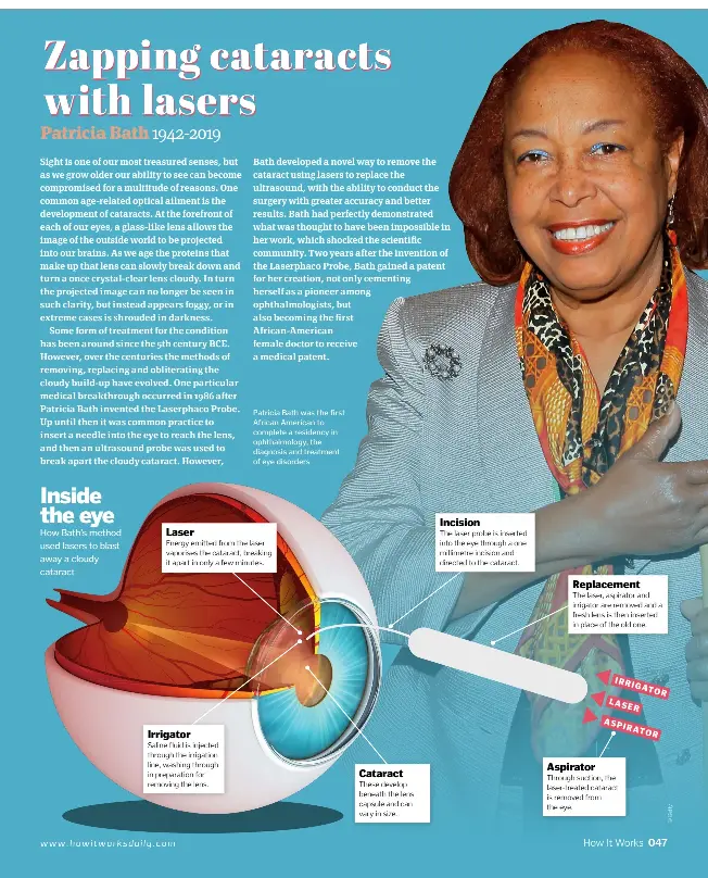 Zapping cataracts with lasers - PressReader