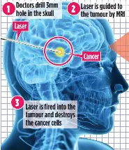 Brain laser that zaps ‘impossible to treat’ tumours - PressReader