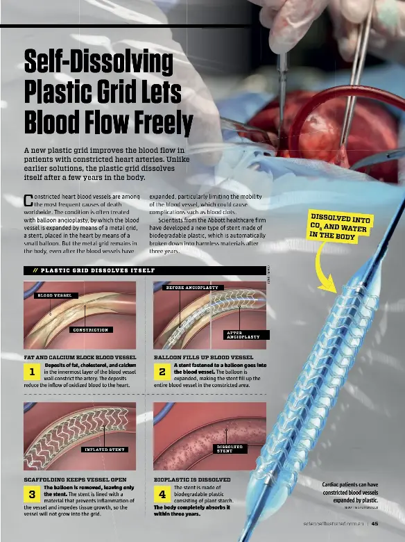 Self-Dissolving Plastic Grid Lets Blood Flow Freely - PressReader
