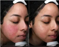 THE ROSY PATH TO RADIANT SKIN: PULSE LIGHT CLINIC'S ROSACEA SOLUTIONS ...