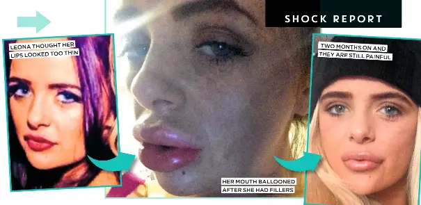 Mum-of-three: “Botched fillers left me with sausage lips” - PressReader