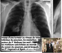 Cancer du poumon : des PROGRÈS SUR TOUS LES FRONTS - PressReader