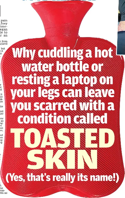 Why cuddling a hot water bottle or resting a laptop on your legs can leave you scarred with a ...