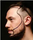 VERY MIXED RESULTS FROM BUDGET FOLLICLE TRANSPLANT IN TURKEY - PressReader