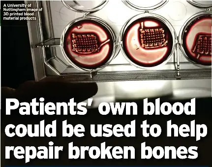 Patients’ own blood could be used to help repair broken bones - PressReader