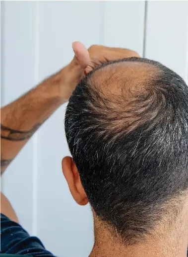 Hair today, but then gone tomorrow? There are ways to tackle baldness ...