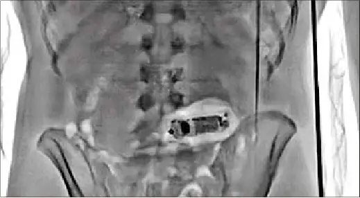 Body scans in prisons to detect smuggling - PressReader