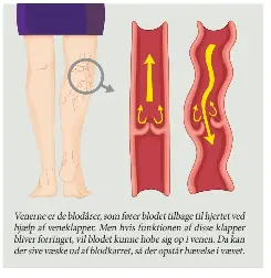 Problemer med vener og traette ben? - PressReader