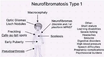 Understand­ing neurofibro­matosis, a relatively unknown genetic ...