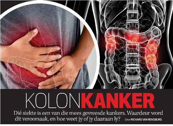 Kolonkanke­r: Als wat jy moet weet oor een van die mees gevreesde ...