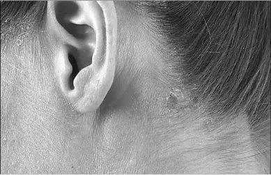 Gezwollen lymfeklier­en: klieren in hals, nek, lies & oksel - PressReader