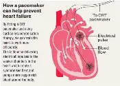 New pacemaker hope for heart failure cases - PressReader