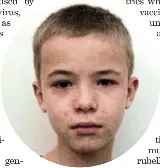 Mumps on the rise in three provinces – NICD - PressReader