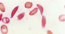 A new cure for sickle cell disease may be coming - PressReader