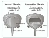 Powerful New Bladder Control Pill Flying Off Shelves - PressReader