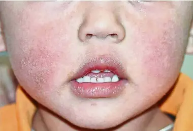 Managing eczema - PressReader