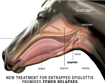 NEW TREATMENT FOR ENTRAPPED EPIGLOTTIS PROMISES FEWER RELAPSES ...