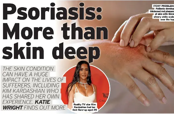 Psoriasis: More than skin deep - PressReader
