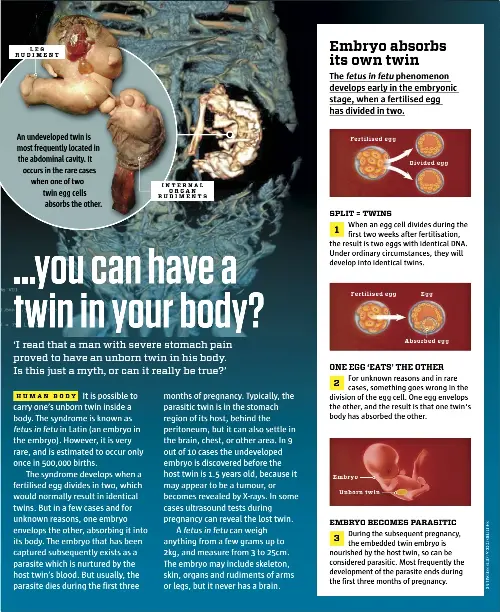 ...you can have a twin in your body? - PressReader