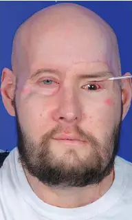 Man who will see through someone else’s eye - PressReader