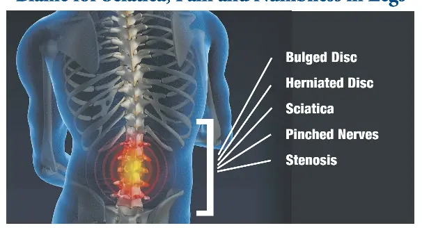 Bulging, Herniated or Worn Discs may be to Blame for Sciatica, Pain and ...