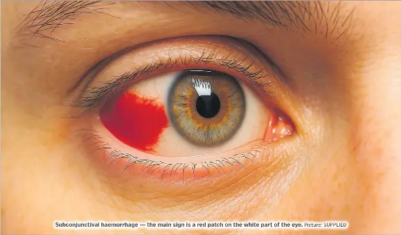 Sub-conjunctiv­al haemorrhag­e - PressReader