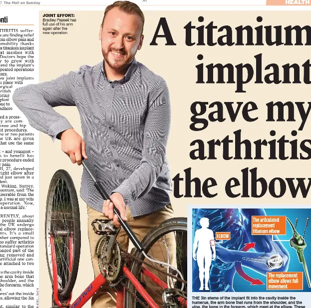 A titanium implant gave my arthritis the elbow - PressReader