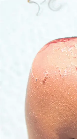 What happens to your body when you’re sunburnt? - PressReader