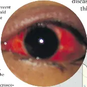 KZN pink eye cases top 13,000 - PressReader