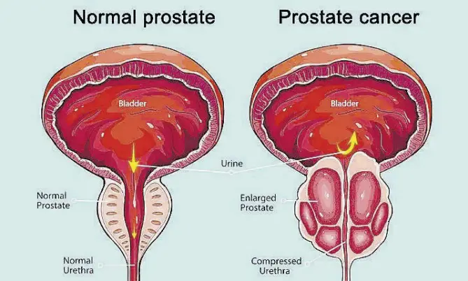 Types of PROSTATE CANCER - PressReader